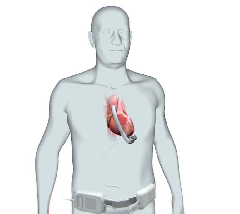 CorWave LVAD - CorWave EN