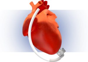 What is an LVAD? - CorWave EN